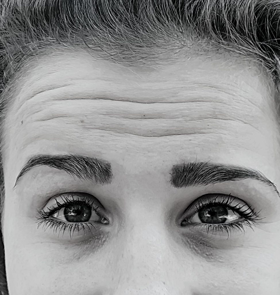 Forehead Wrinkle Treatments in Colorado Springs | SBS