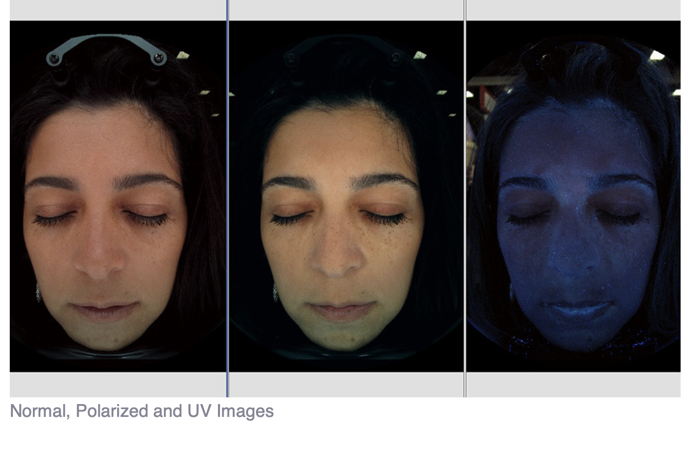 3D Skin Analysis - Springs Body Sculpting