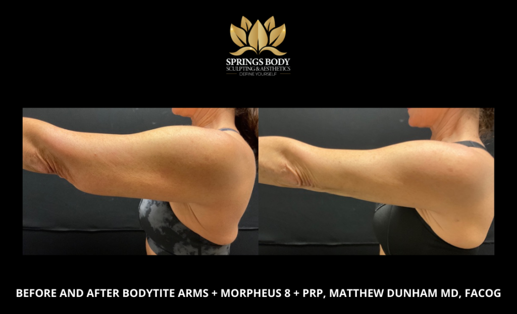 Before & After Image Gallery | Springs Body Sculpting