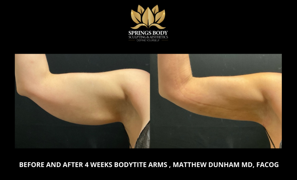 Before & After Image Gallery | Springs Body Sculpting
