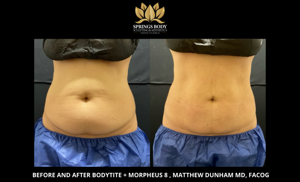 Before & After Image Gallery | Springs Body Sculpting