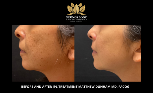 Before & After Image Gallery | Springs Body Sculpting